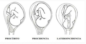 Prolapso de Cordón Umbilical - Dr. José María Muñoz Conde | Ginecólogo ...