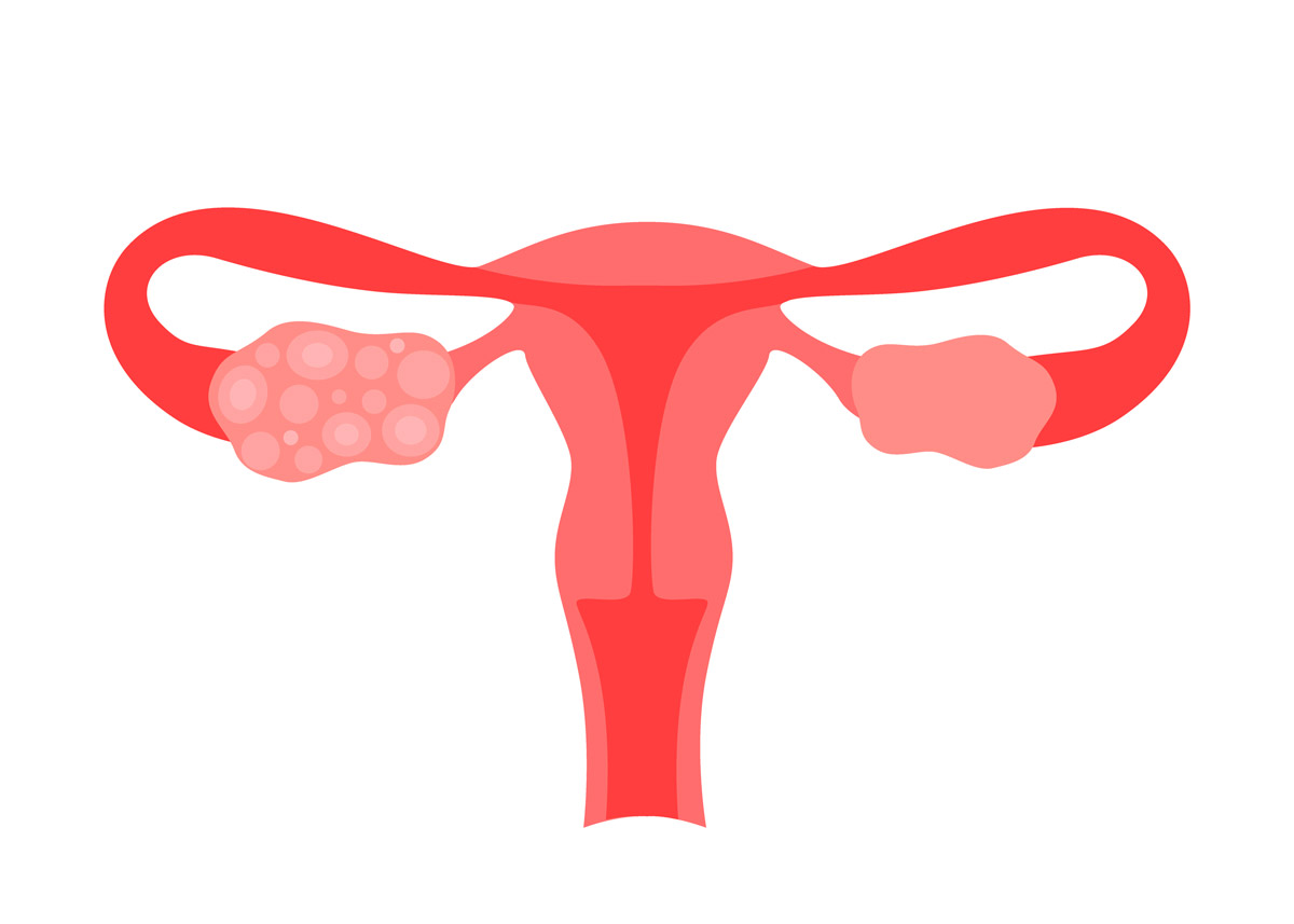 Quistes de Ovario - Dr. José María Muñoz Conde | Ginecólogo en Carmona